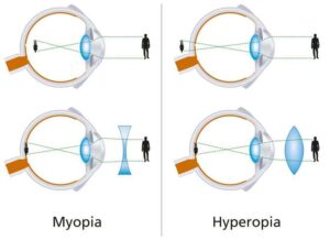 Myopia vs hyperopia - EyesMatterMost