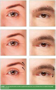 Sanpaku eyes- things you must know about it - EyesMatterMost