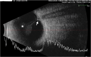 B-scan- things you must know about it - EyesMatterMost