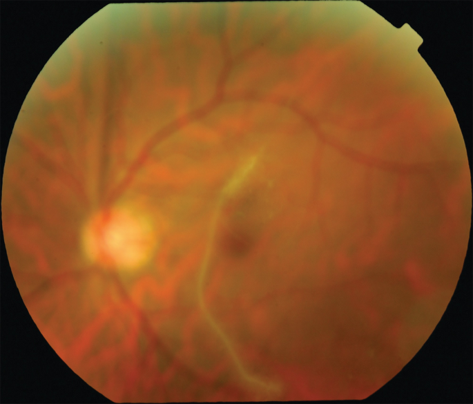 Why ophthalomologists avoid cataract surgery in high myopia ...