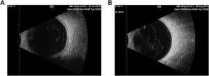 B-scan- things you must know about it - EyesMatterMost
