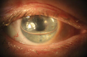 Air bubble in the eye- post surgery - EyesMatterMost